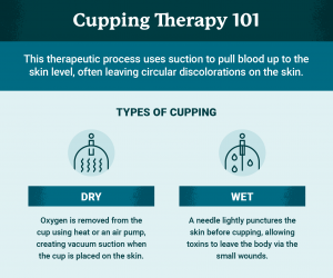 What Is Cupping Therapy? Benefits and Applications | USAHS