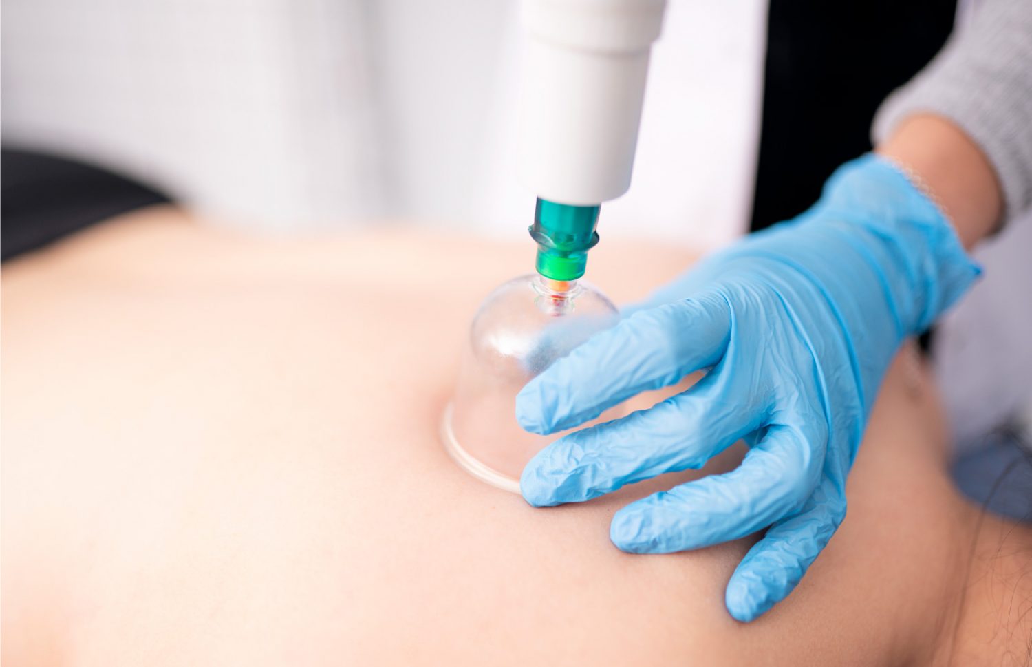 What Is Cupping Therapy? Benefits and Applications | USAHS